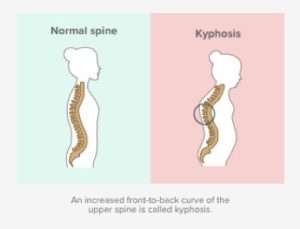 Kyphosis - Huffman Spine Clinic