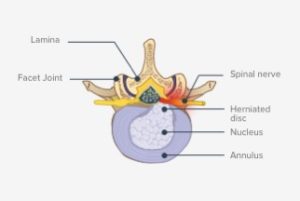 Lumbar Microdiscectomy - Huffman Spine Clinic
